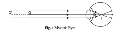 The figure shows a human eye suffering from a certain type of defect in ...