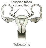 Correct surgical method of contraception is a) Ovariectomy b ...