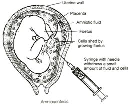 Amniocentesis is the detection of a) Chromosomal pattern by taking ...